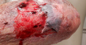 Top ten tips: preventing and treating skin tears – Wounds Asia